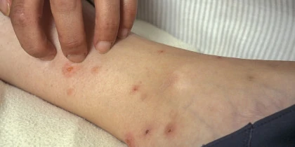 How to Get Rid of Fleas on Humans – Repellents & Treatment